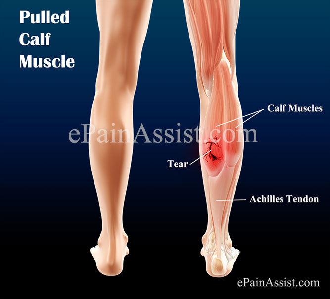 Pulled Calf Muscle Causes Classification Treatment Exercises Pulled Calf Muscle Causes Classification Treatment Exercises