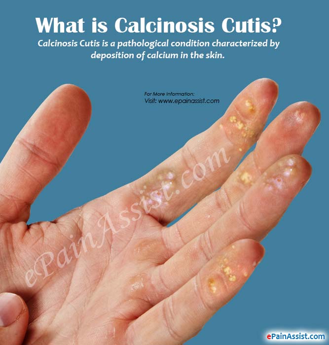 Calcinosis Cutis Causes Symptoms Treatment Diagnosis Calcinosis Cutis Causes Symptoms Treatment Diagnosis