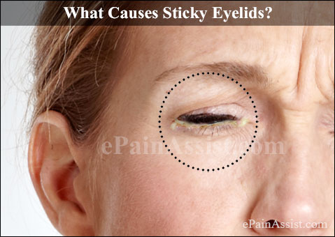 What Causes Sticky Eyelids & How is it Treated?