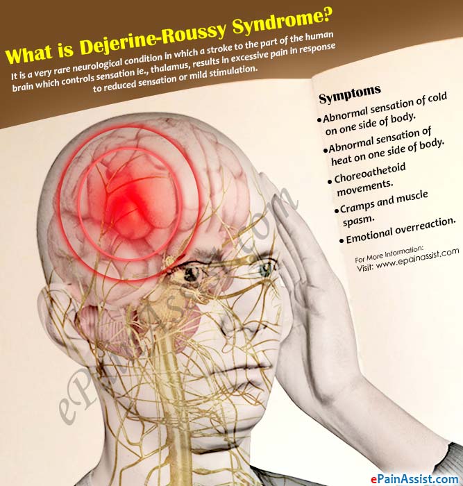 What Is Dejerine Roussy Syndrome Or Thalamic Pain Syndrome Causes What Is Dejerine Roussy Syndrome Or Thalamic Pain Syndrome Causes