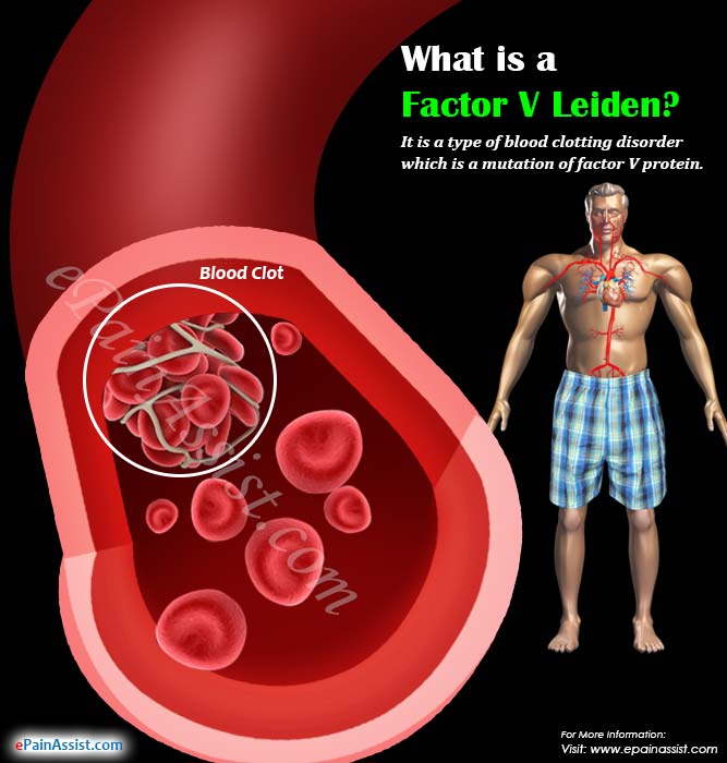 Factor V Leiden Causes Symptoms Treatment Recovery Prognosis Prevention Factor V Leiden Causes Symptoms Treatment Recovery Prognosis Prevention