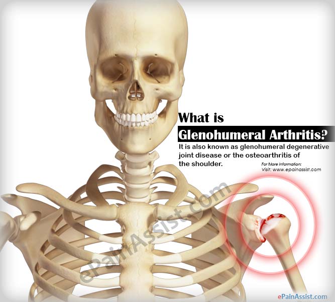 Glenohumeral Arthritis Causes Symptoms Treatment Prognosis 