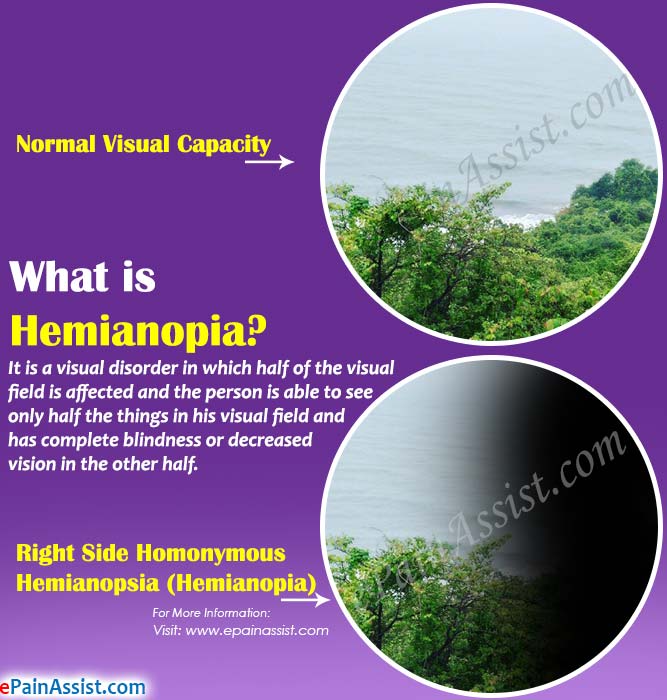 Homonymous Hemianopia Treatment Homonymous Hemianopia Treatment
