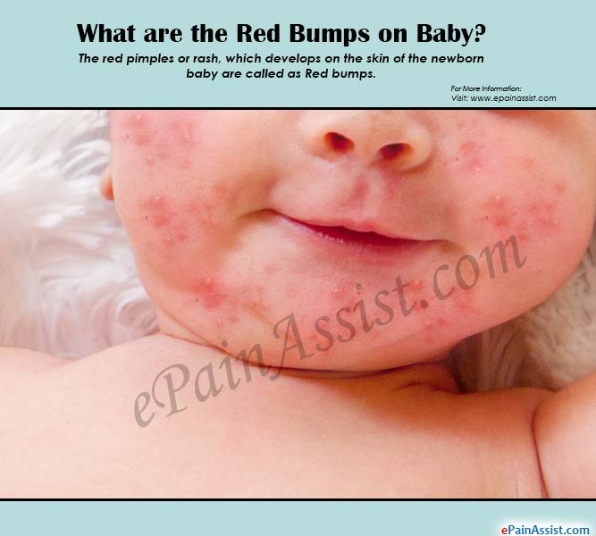 Red Bumps On Baby Causes Symptoms Treatment Prognosis Prevention